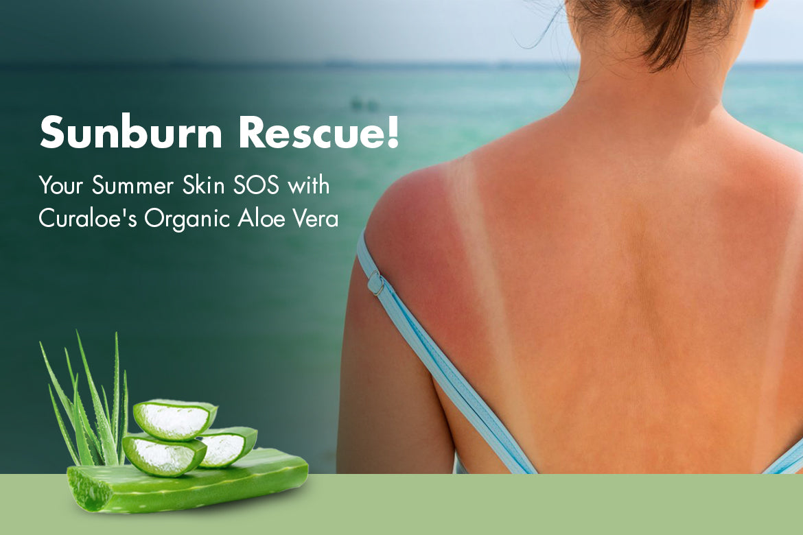 Sunburn Relief & Hydration with Curaloe Aloe Vera Care